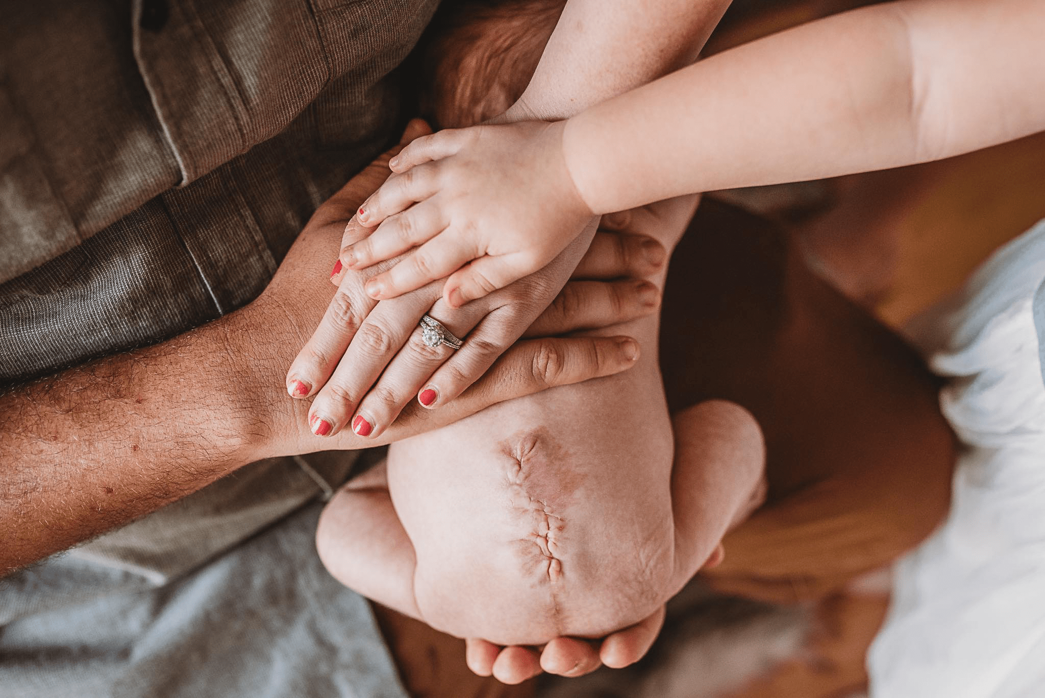 In Utero Surgery Improves Outcomes For Babies With Spina Bifida